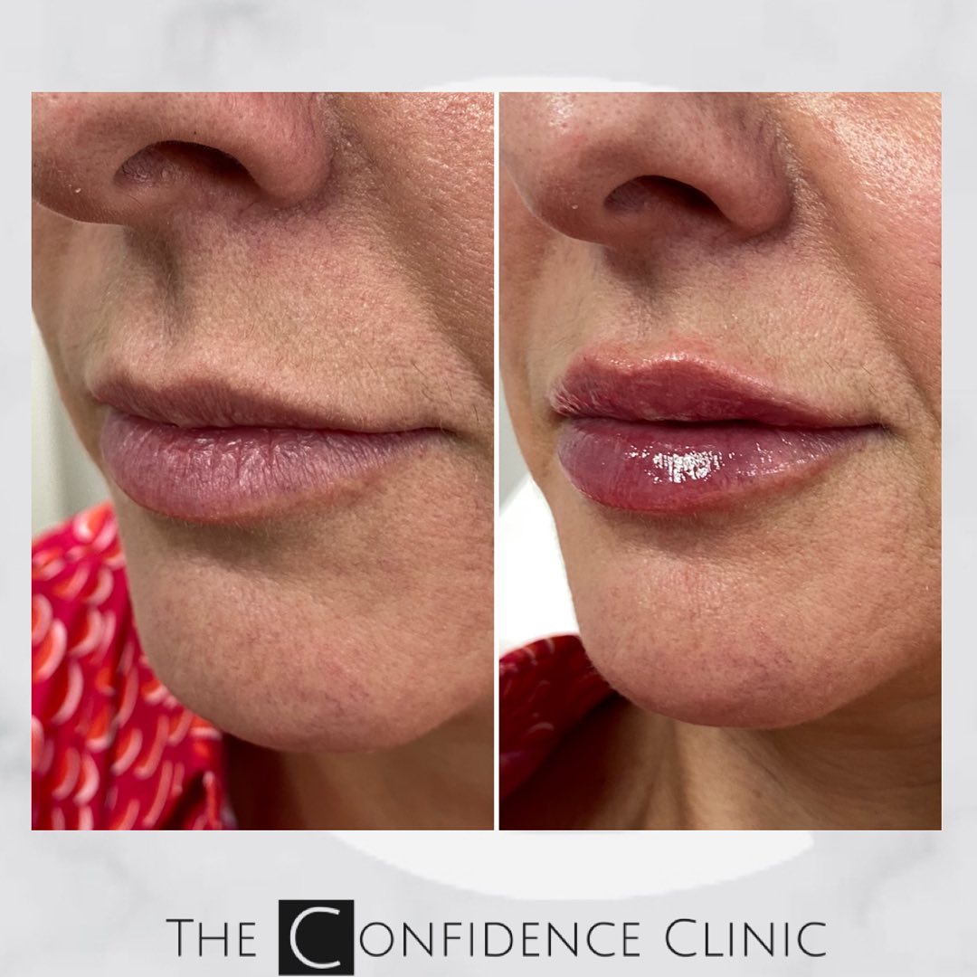 Building up the lips with 0.5 ml enhancement – theconfidenceclinic